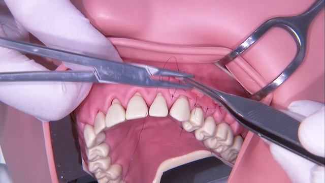 Пластическая хирургия пародонта (13 часть, закрытие раны, небной)