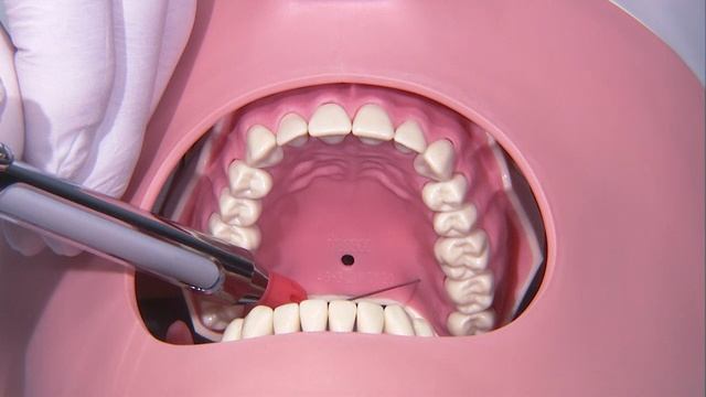 Местная анестезия (4 часть, проводниковая анестезия большого небного нерва)