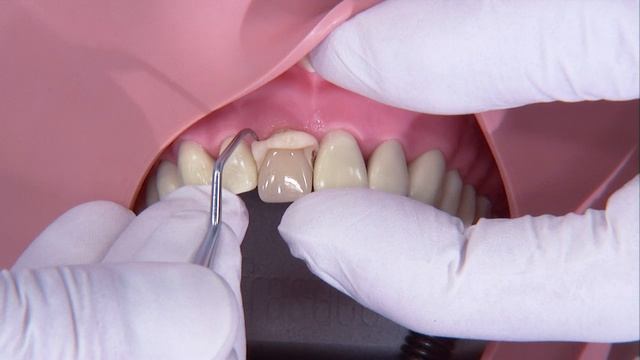 Изготовление временной коронки (8 часть, снятие ленточной коронки)
