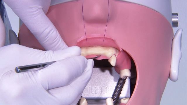 Имплантология (4 часть, мобилизация слизистой оболочки неба, поднятие небного лоскута)