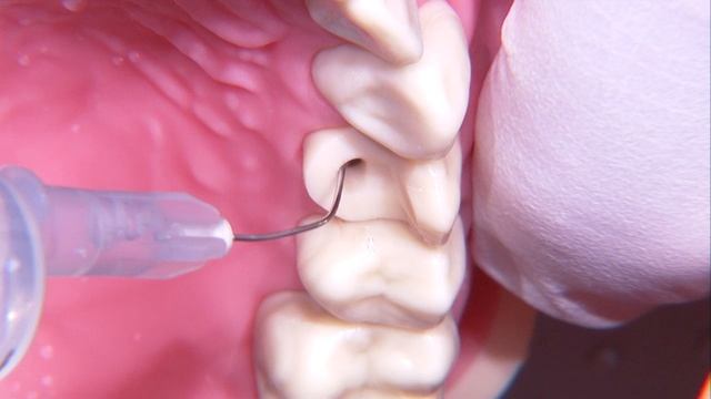 Восстановление культи зуба (5 часть, дезинфекция корневого канала)