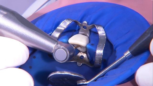 Эндодонтия (3 часть, расширение корневого канала)