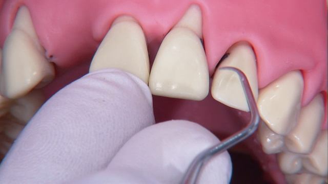 Удаление зубного камня (3 часть, кюретаж)