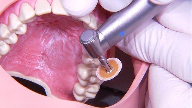 Восстановление культи зуба (16 часть, завершение сердцевины диском)