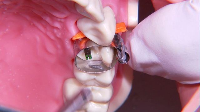 Восстановление культи зуба (13 часть, бондинг и светоотверждение)