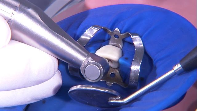 Эндодонтия (5 часть, подготовка корневого канала, файл ISO 35) Симуляция.