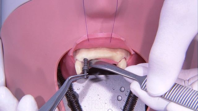 Имплантология (9 часть, измерение глубины)