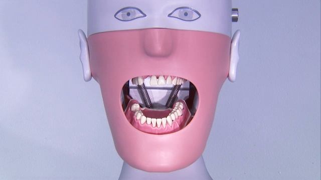 Альгинатный оттиск (1 часть, примерка оттискных ложек на верхнюю и нижнюю челюсти)