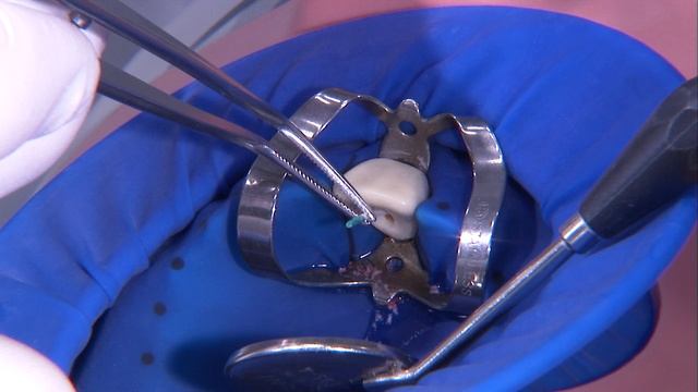 Эндодонтия (7 часть, высушивание канала бумажными штифтами)