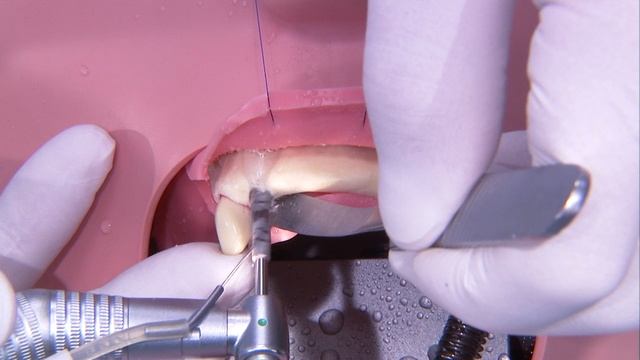 Имплантология (14 часть, корректировка подготовленного участка)