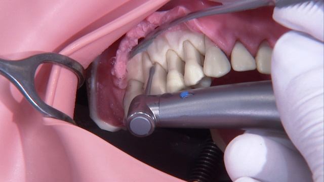 Пародонтальная хирургия (9 часть, полировка корня с помощью Perio-Set)