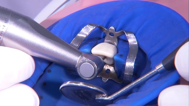 Эндодонтия (4 часть, подготовка корневого канала, файл ISO 25)