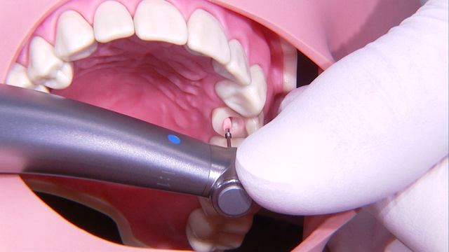 Восстановление культи зуба (1 часть, фреза Largo (удаляет гуттаперчу))