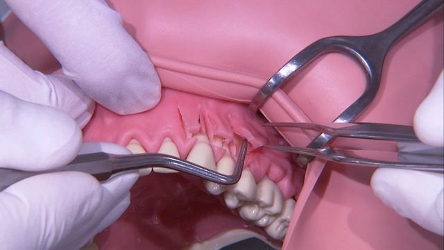 Пластическая хирургия пародонта (5 Формирование щечного лоскута (полнослойного слизистого лоскута)