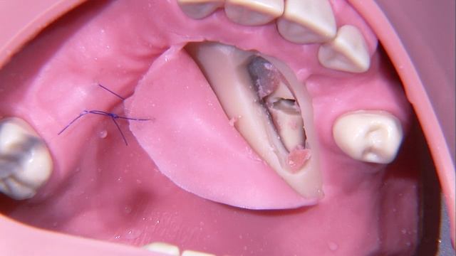 Оперативное удаление ретенированного клыка (9 часть, удаление зубного фолликула)