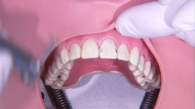 Реставрация передних зубов (15 часть, отделка и полировка дисками)