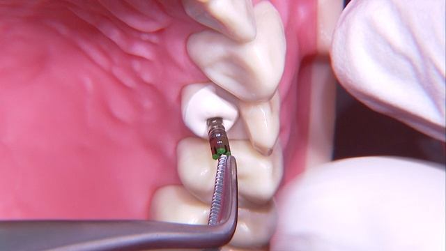 Восстановление культи зуба (7 часть, фиксация штифта фосфатным цементом)