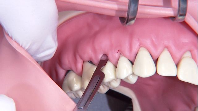 Пародонтальная хирургия (1 часть, разрез, щечный)