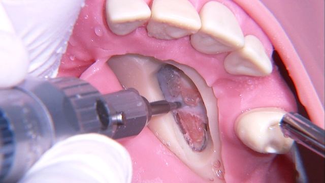 Оперативное удаление ретенированного клыка (7 часть, донтотомия с использованием фрезы Линдемана)