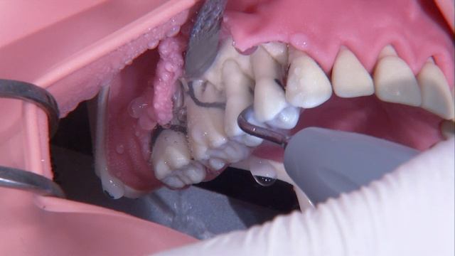 Пародонтальная хирургия (7 часть, ультразвуковая чистка зубов)