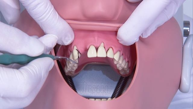 Удаление зубного камня (1 часть, диагностика пародонтита)