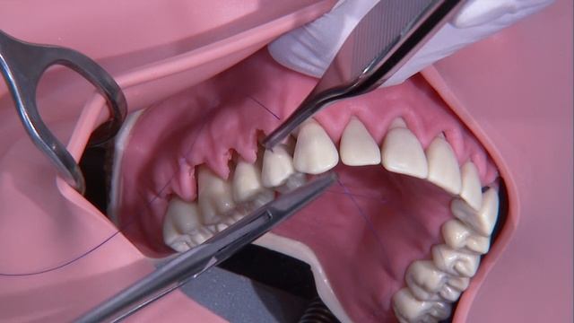 Пародонтальная хирургия (11 часть, закрытие раны пуговичными швами)