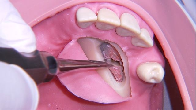 Оперативное удаление (8 часть, одонтотомия с использованием элеватора Бейна) Симуляция.