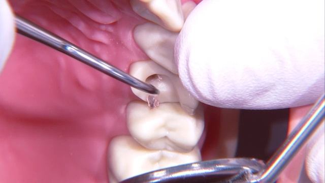 Восстановление культи зуба (3 часть, очистка полости)