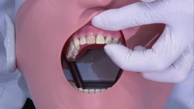 Изготовление временной коронки (12 часть, установка временной реставрации)