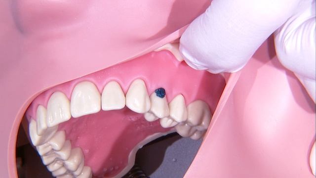 Восстановление шейки зуба (5 часть, офорт)