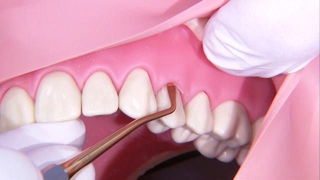 Восстановление шейки зуба (7 часть, нанесение и заполимеризирование пломбировочного материала)