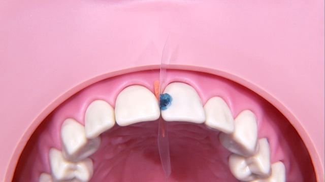 Реставрация передних зубов (8 часть, кислотное травление эмали)