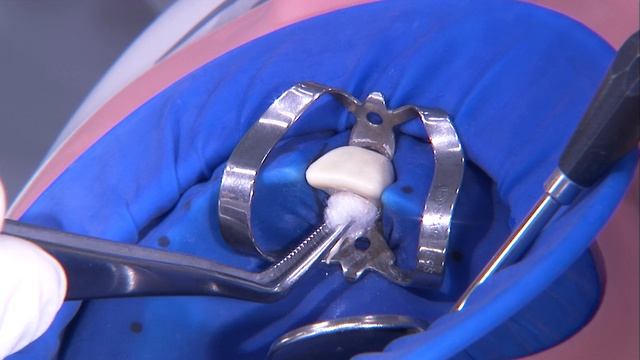 Эндодонтия (11 часть, удаление излишков цемента)