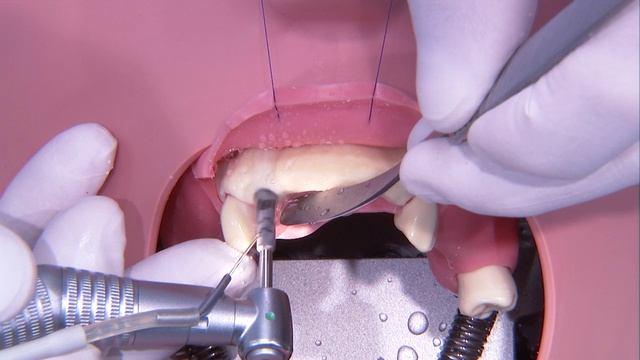 Имплантология (11 часть, подготовка места сверления с помощью спирального сверла)