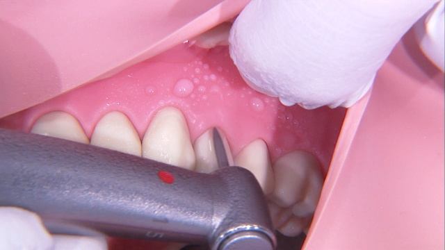 Восстановление шейки зуба (8 часть, отделка и полировка)