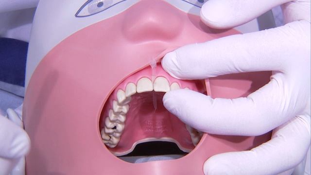 Реставрация передних зубов (12 часть, удаление клина и матрицы)