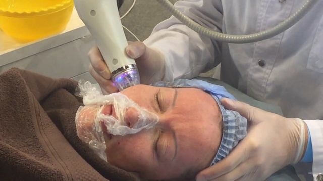 Фракционный RF-лифтинг