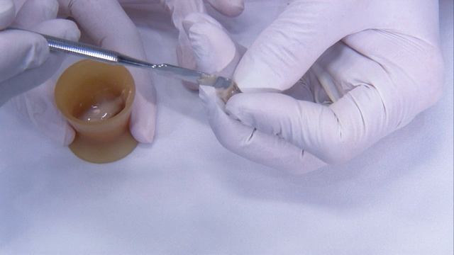 Изготовление временной коронки (6 заполнение полосовой коронки временным пломбировочным материалом)