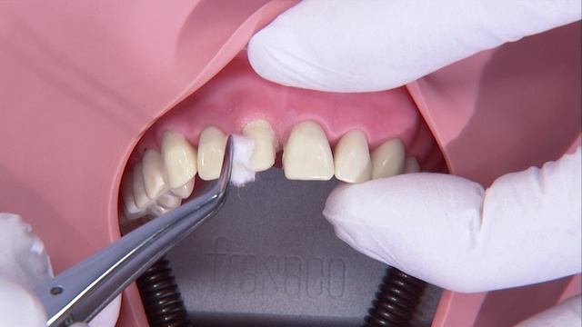 Изготовление временной коронки (5 часть, изоляция препарата)