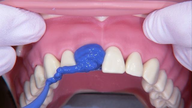 Ретракция десны и получение окончательного оттиска (3 часть, окончательное впечатление)