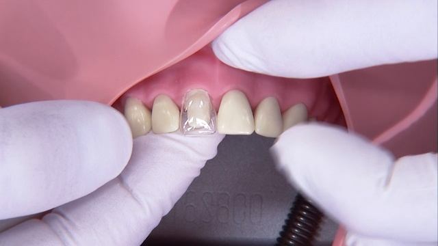 Изготовление временной коронки (4 часть, примерка короны из вырезанной полоски)