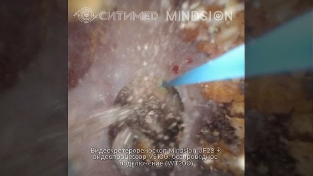 Контактная литотрипсия, многоразовый видеоуретерореноскоп Mindsion UF28, беспроводное подключение