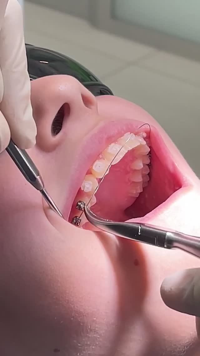 Брекеты - детская ортодонтия