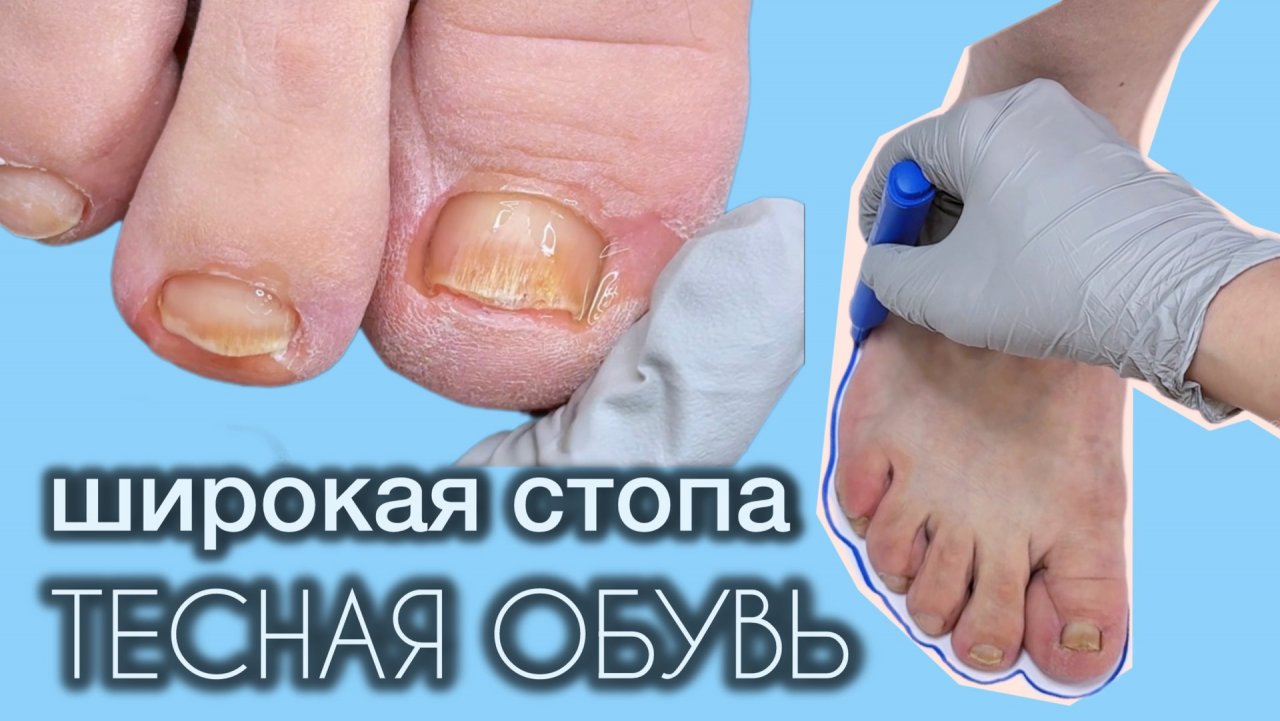 Широкая стопа + тесная обувь = стержневые мозоли, предногтевые мозоли, вросшие ногти, толстые ногти
