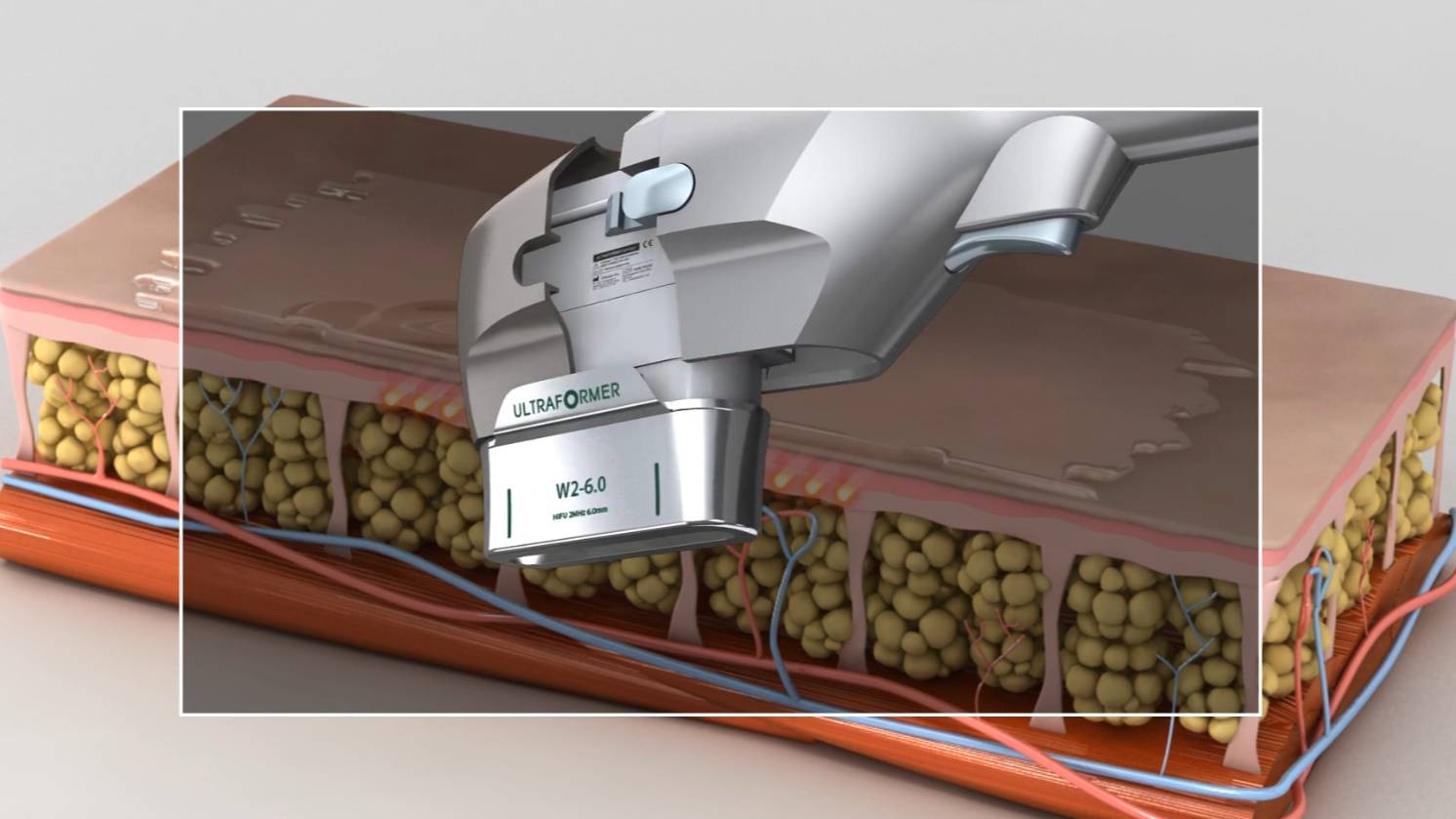 Процедура Ultraformer