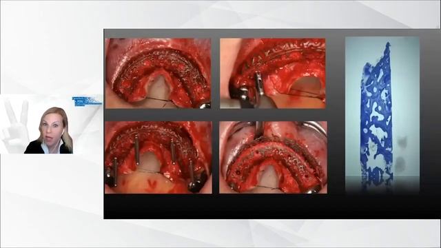 Амели Хартман, Германия. Обширная костная аугментация.