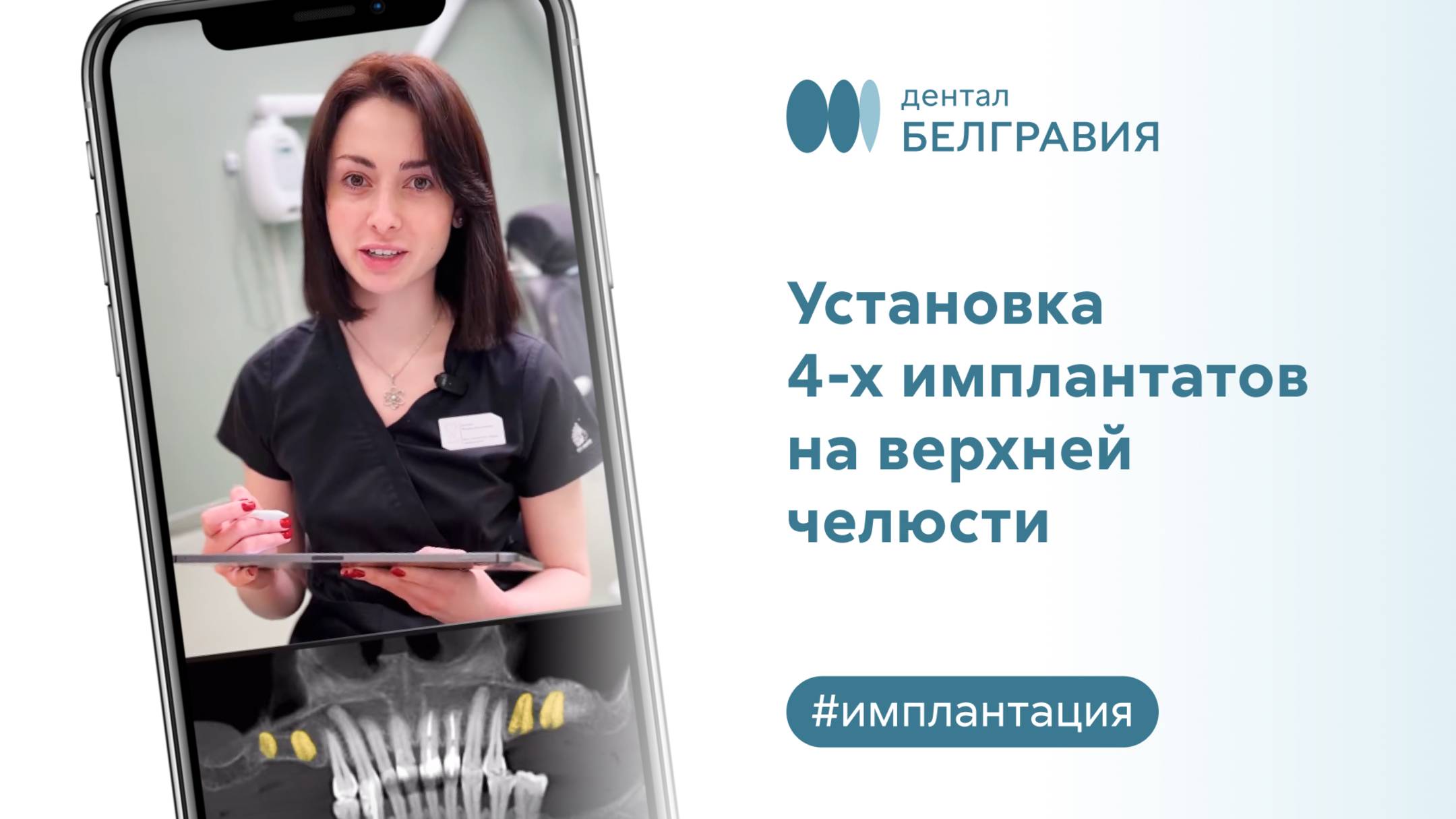 Установка 4-х имплантатов на верхней челюсти. Процесс имплантации зубов