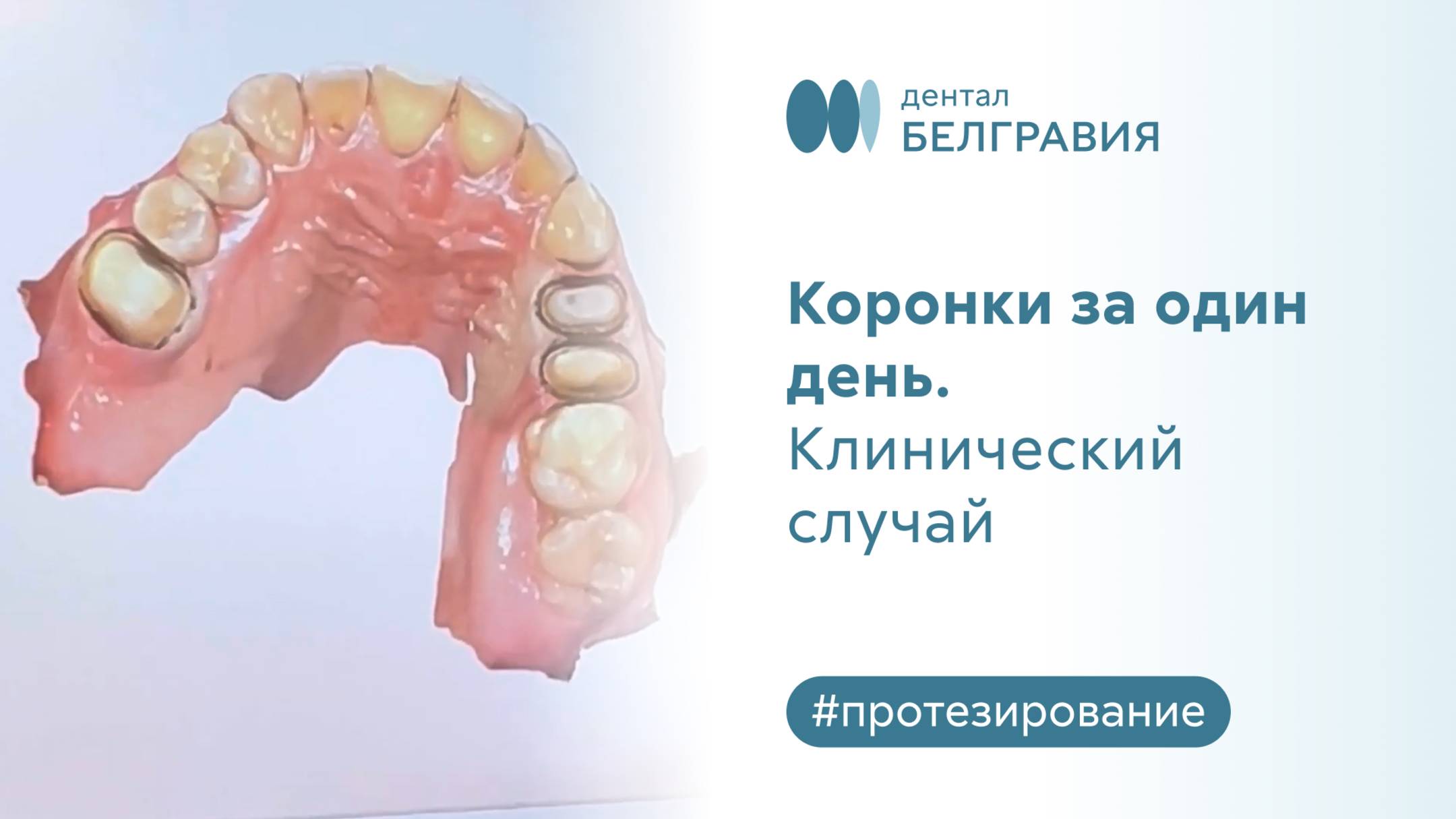 Коронки за один день. Клинический случай