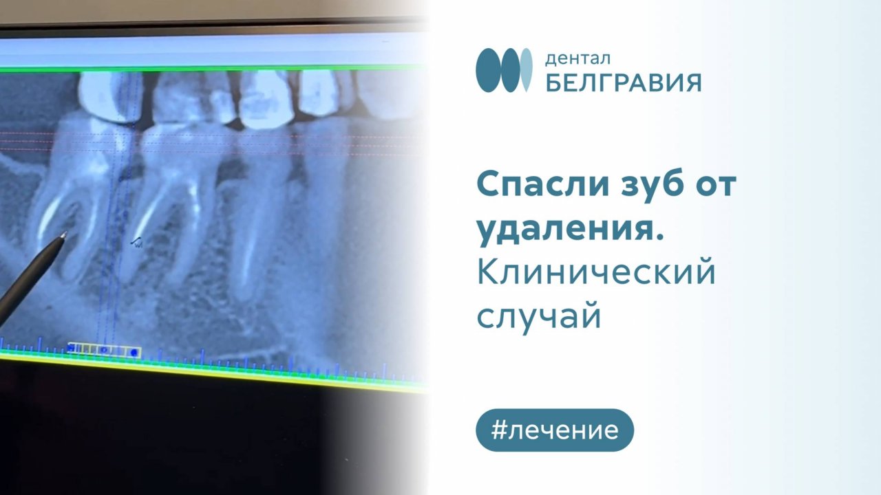 Спасли зуб от удаления. Клинический случай Belgravia Dental Studio