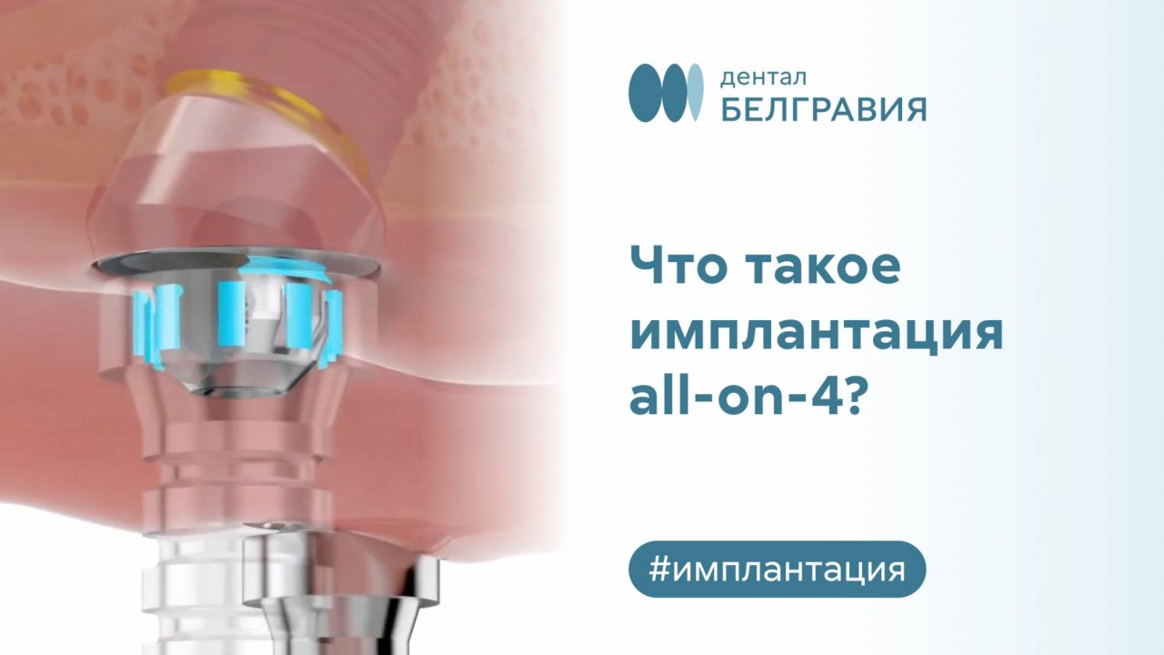 Что такое имплантация all-on-4?